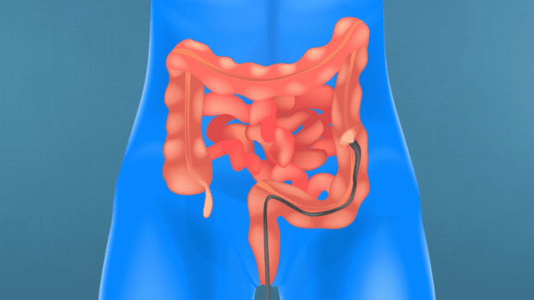 Retossigmoidoscopia flexível | Gastroendo